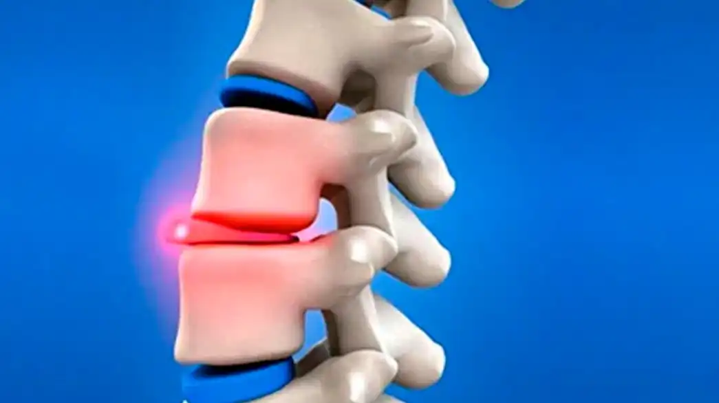 5 Síntomas de la Hernia Discal - Osoat.com